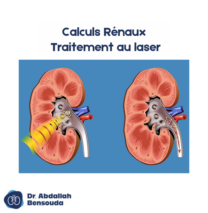 Calculs Rénaux Rabat Agdal : Traitement Laser Sans Douleur