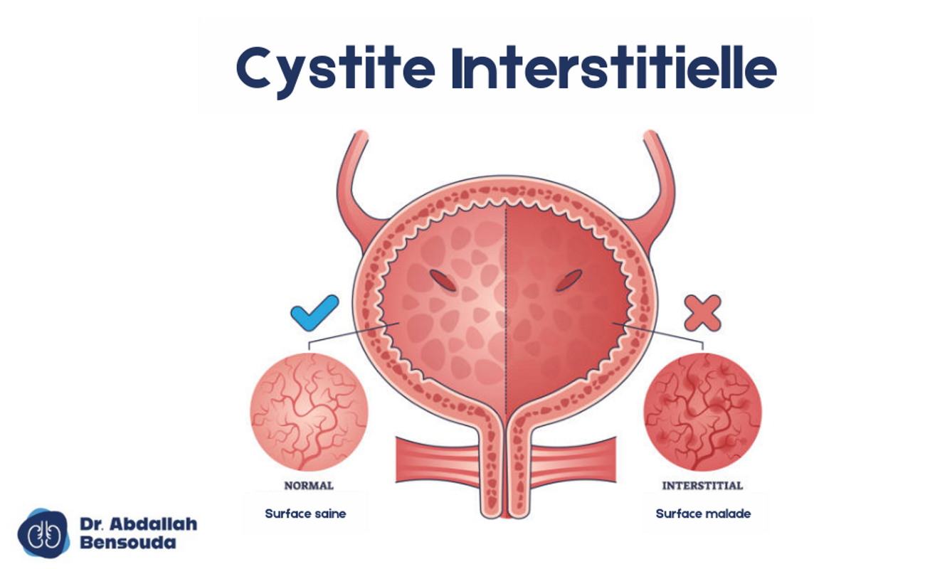 Cystite Interstitielle Rabat : Traitements & Chirurgie