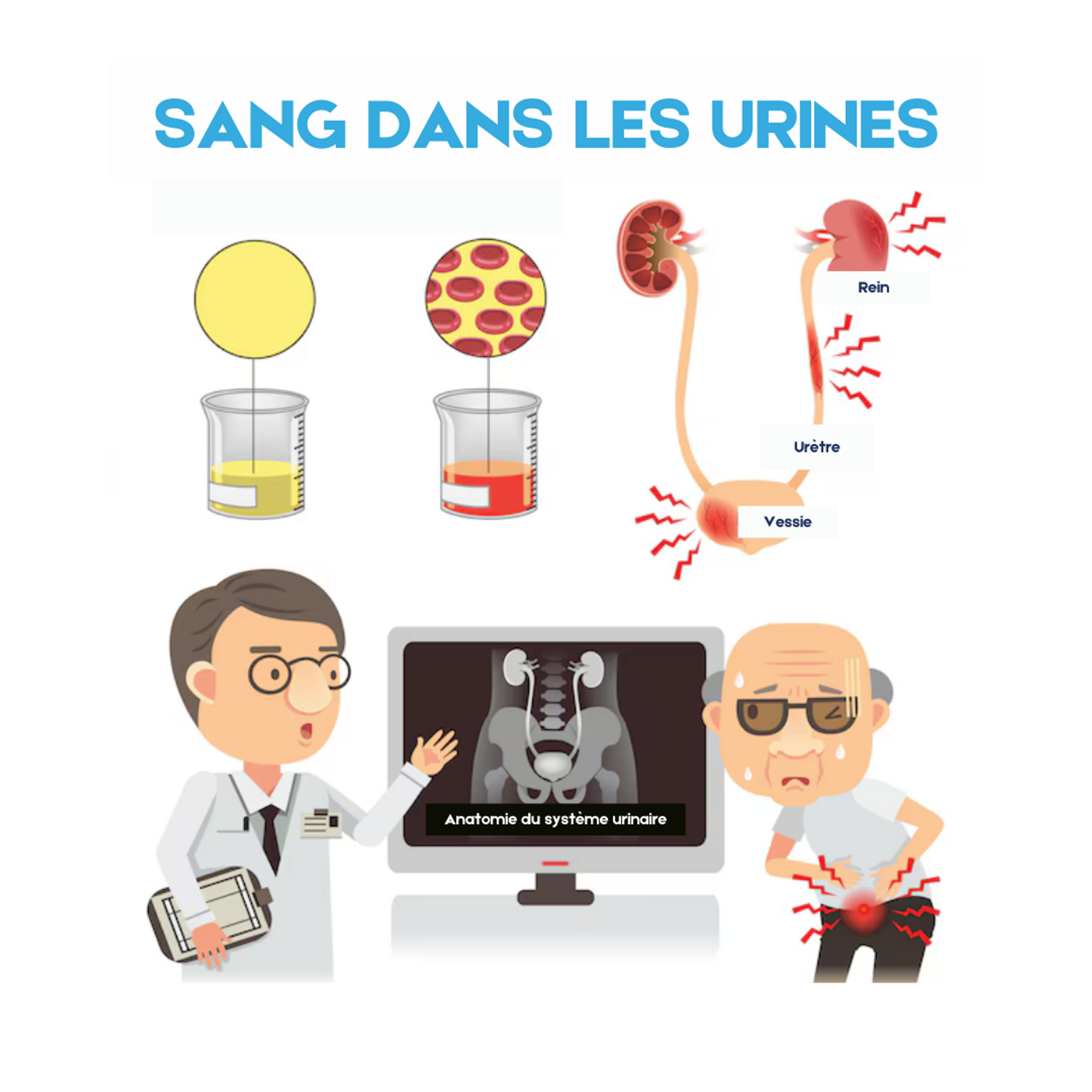 L'hématurie : Du sang dans ses urines ! Consultez